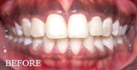 Laser Gum Whitening Philadelphia | Gum Depigmentation